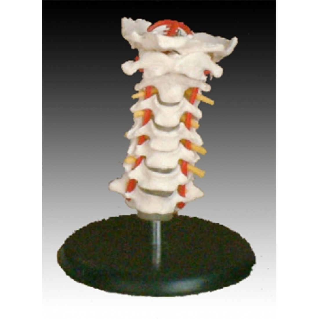 Cervical vertebral column with neck artery, occipital, herniated ...